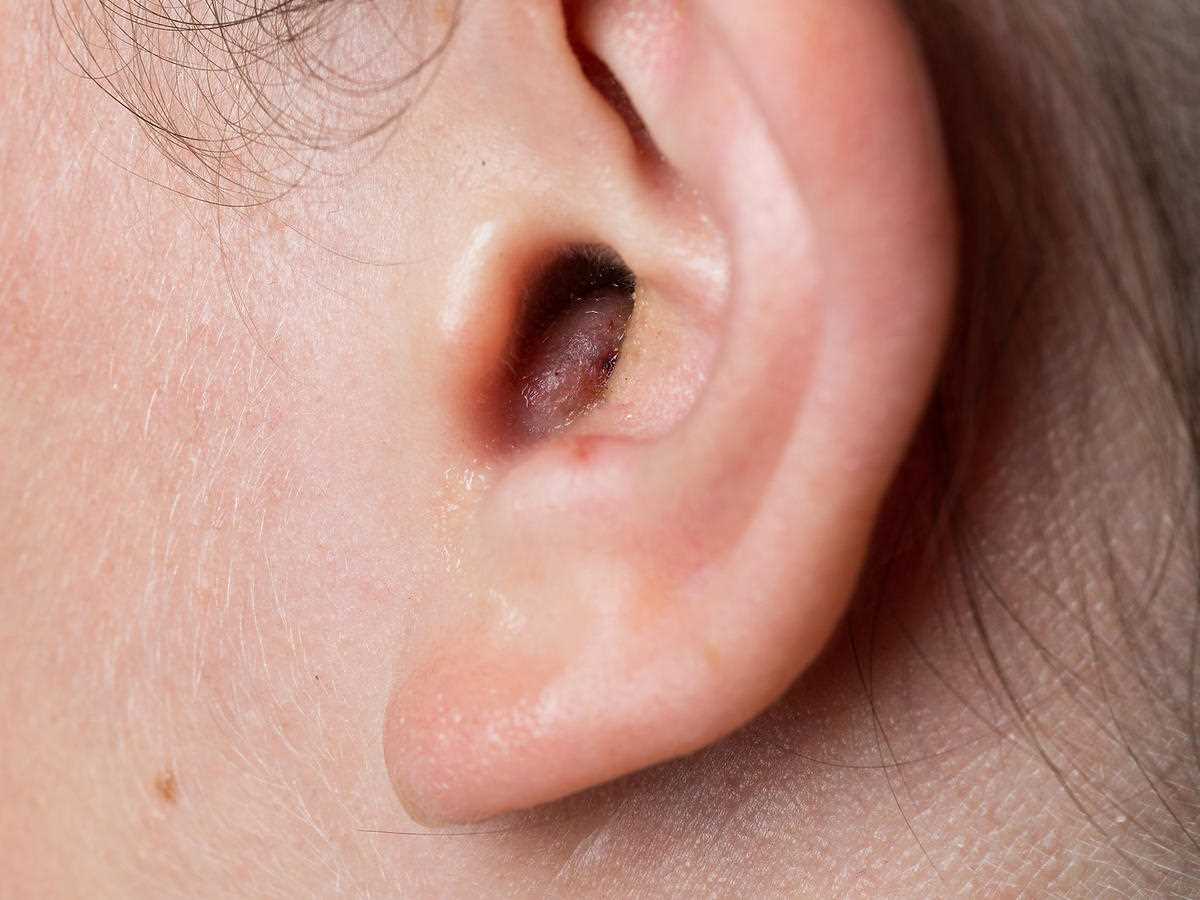 Krosta w uchu - przyczyny, objawy i leczenie | Porady zdrowotne ...