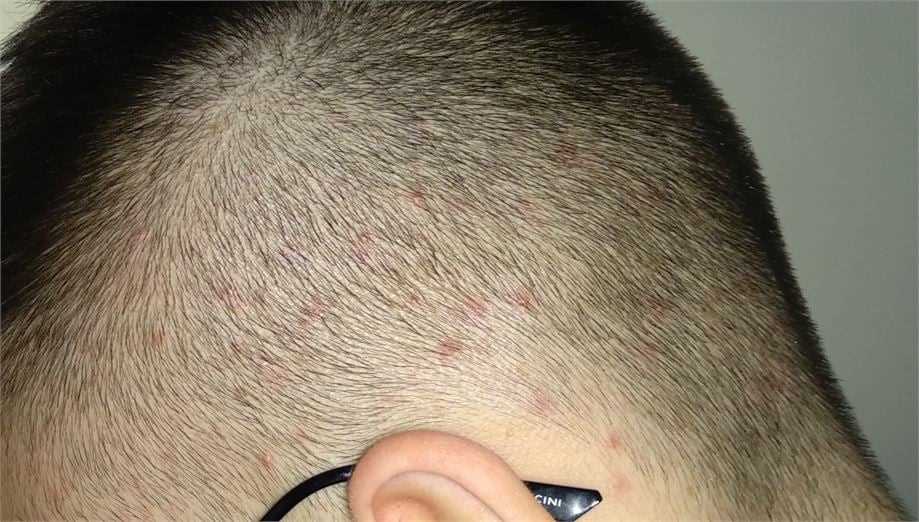 Ropne krosty na głowie we włosach: przyczyny, objawy i sposoby leczenia ...